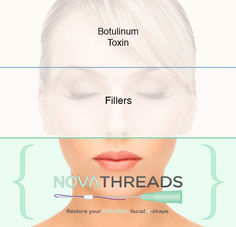 NOVA Threads | PDO Thread Lift | Non-Surgical Face Lift St Petersburg FL